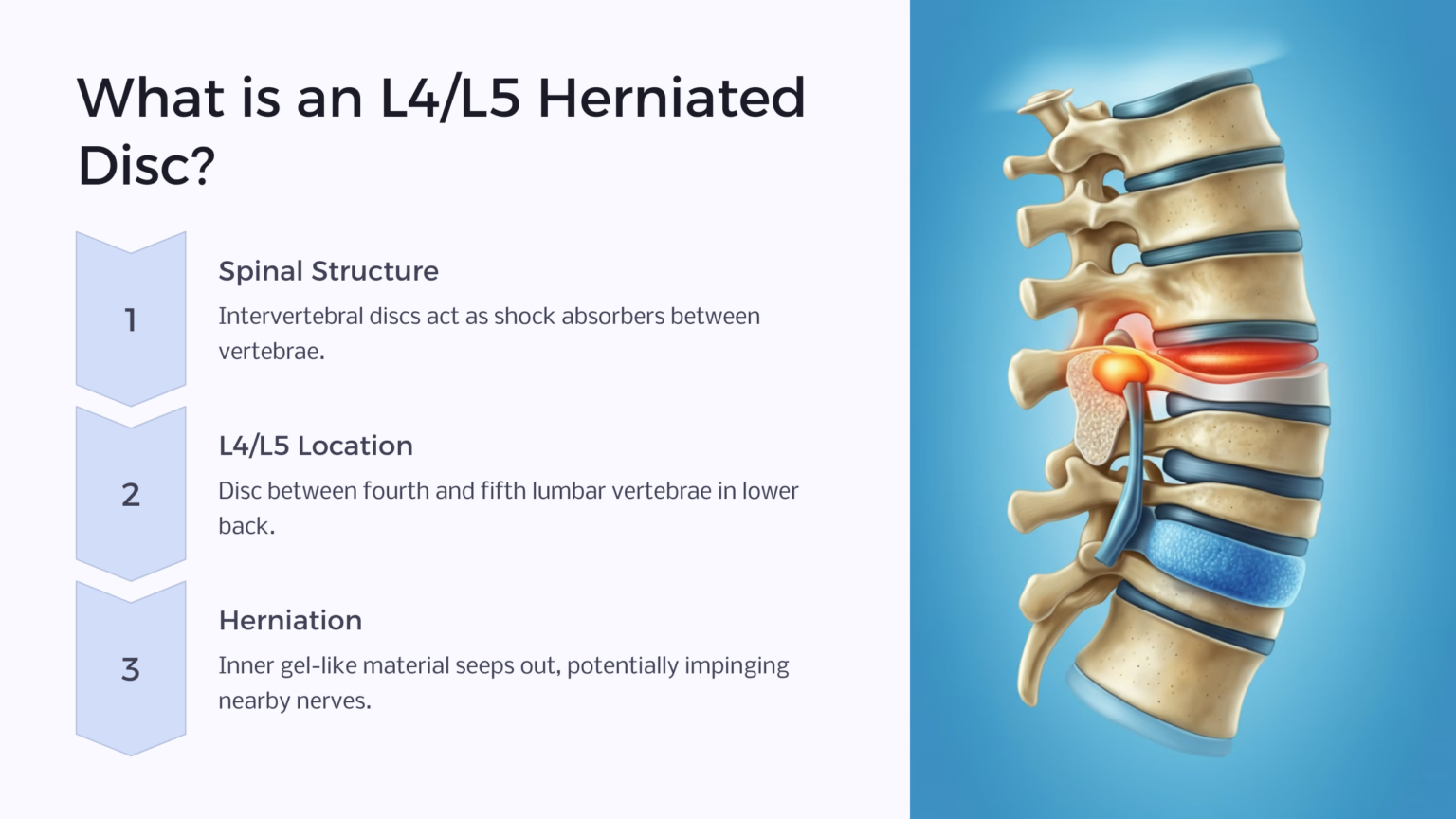 Disability For an L4/L5 Herniated Disc - Benefits.com - We Make ...